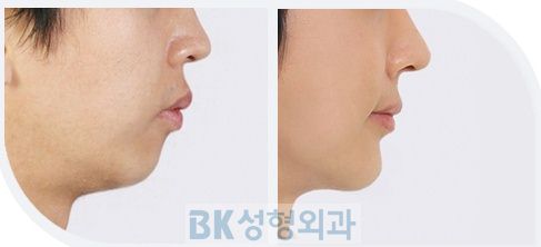 BK Plastic Surgery: ADVANCED EXPERTISE IN FACIAL CONTOURING; BK ...