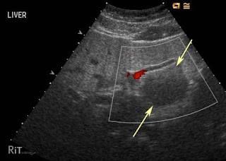 RiT radiology: Focal Fat Sparing