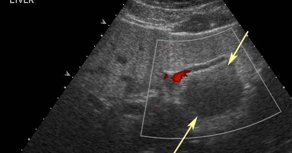 RiT radiology: Focal Fat Sparing