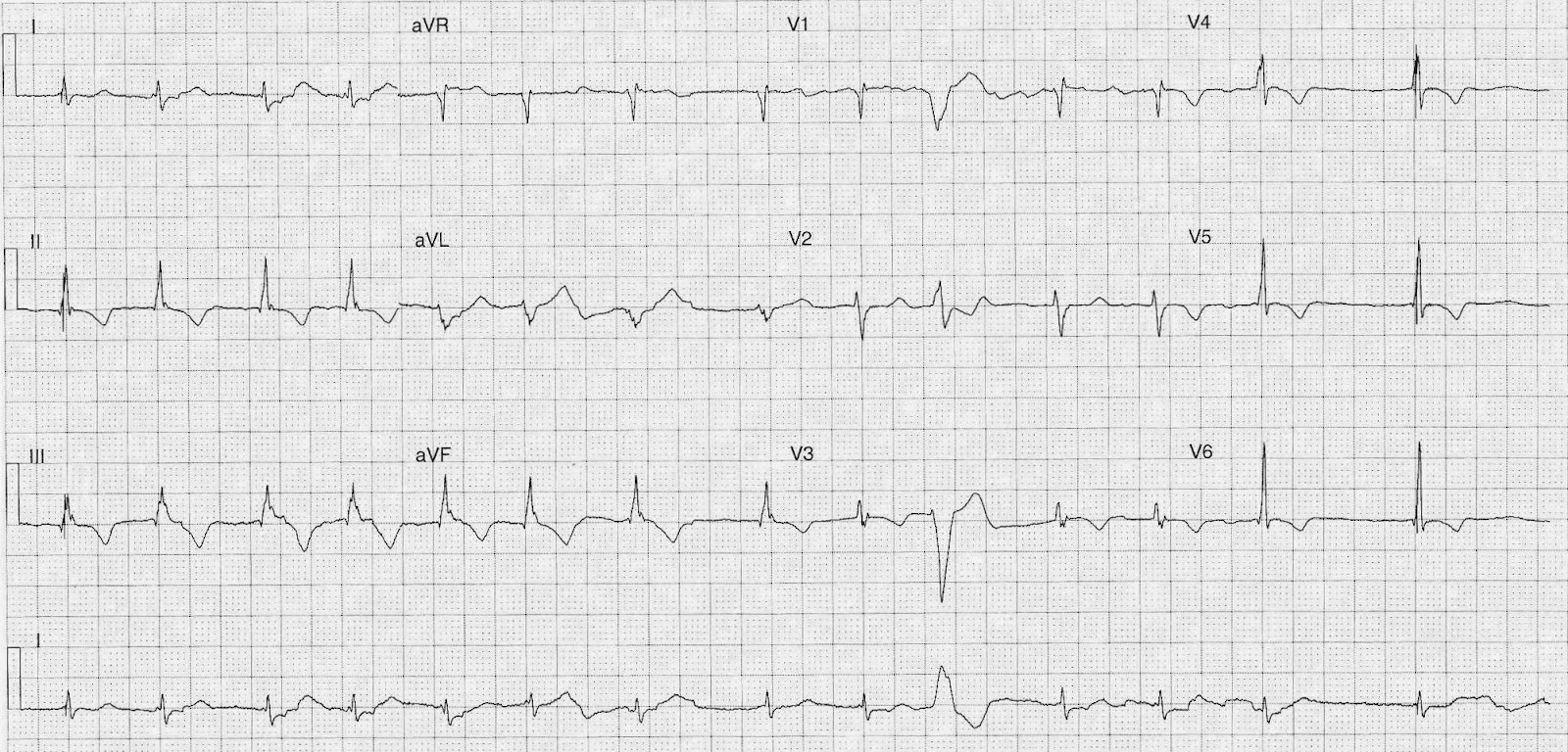 ECG of the Week: ECG of the Week - 6th August 2012 - Interpretation