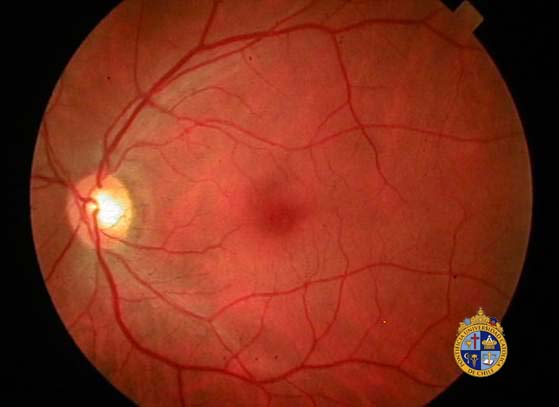 Guía de Estudio IBC: La Exploración del Fondo de ojo