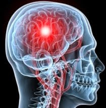 Salud Vida y Consejos: COMO DETECTAR Y DETENER UNA EMBOLIA