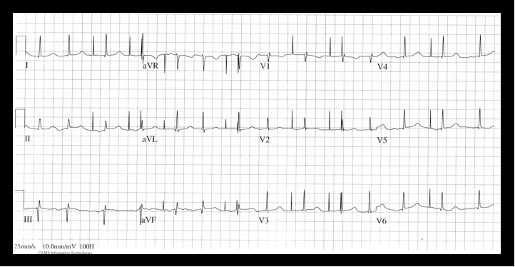 Cardiac Nurse: Teaching As I Learn: Defining Incomplete Right Bundle ...