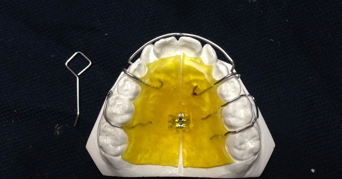 V OPEN LAB : Arco de Hawley con tornillo de expansión