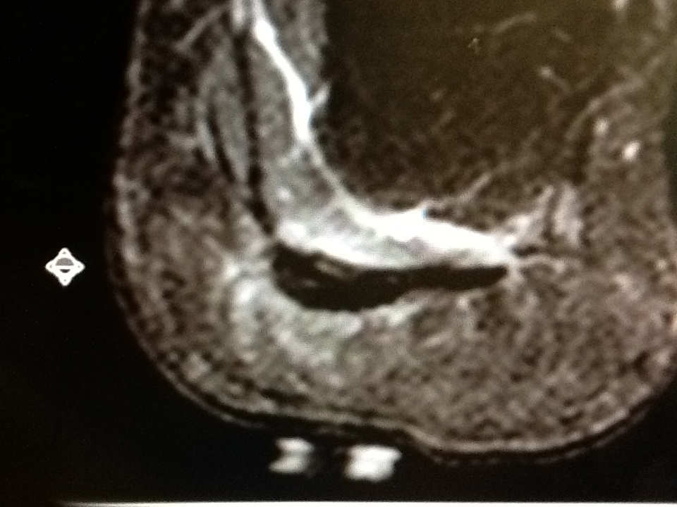 Foot and Ankle Problems By Dr. Richard Blake: Plantar Fasciitis: MRI ...