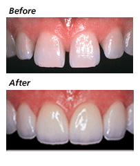 Tooth & Gums: Diastema