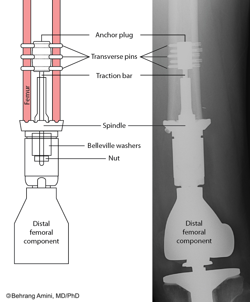 Roentgen Ray Reader: Compress Compliant Pre-Stress Implant