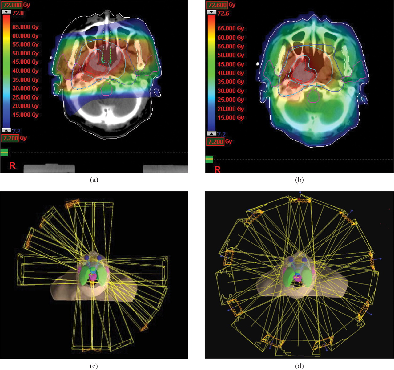 OFF TO TANZANIA..: Radiotherapy In the UK.. VS.. Radiotherapy In ORCI..