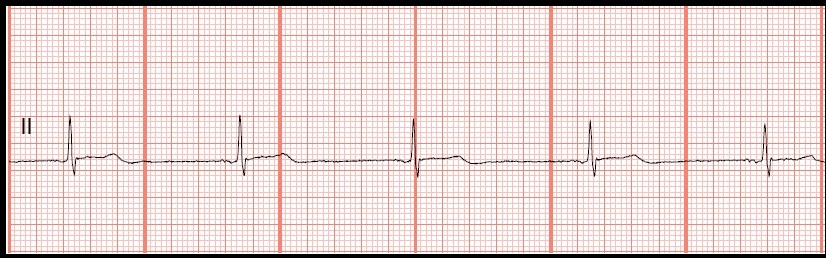 Characteristics of Junctional Rhythms