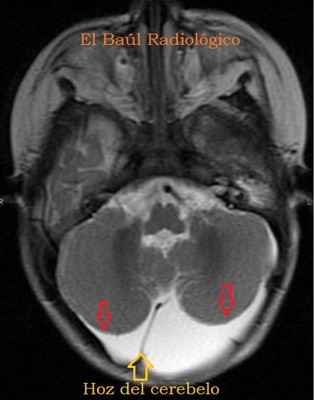 El Baúl Radiológico: ASPECTO DE LA CISTERNA MAGNA EN TOMOGRAFÍA ...