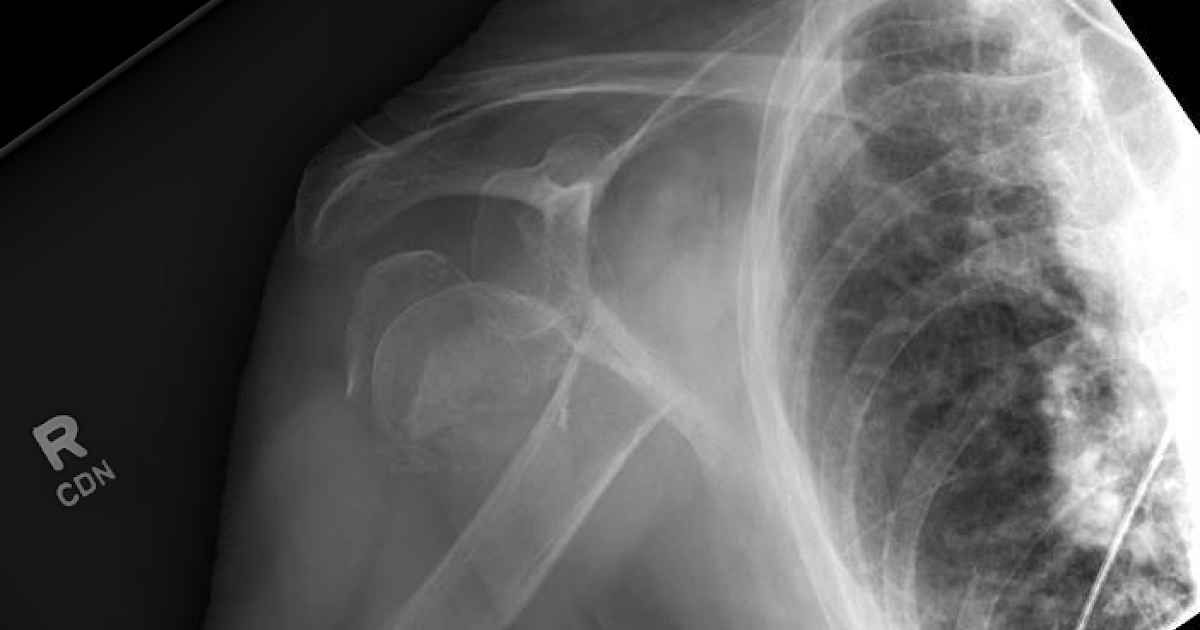 Shoulder and Elbow Surgery: Open reduction and internal fixation of a 4 ...