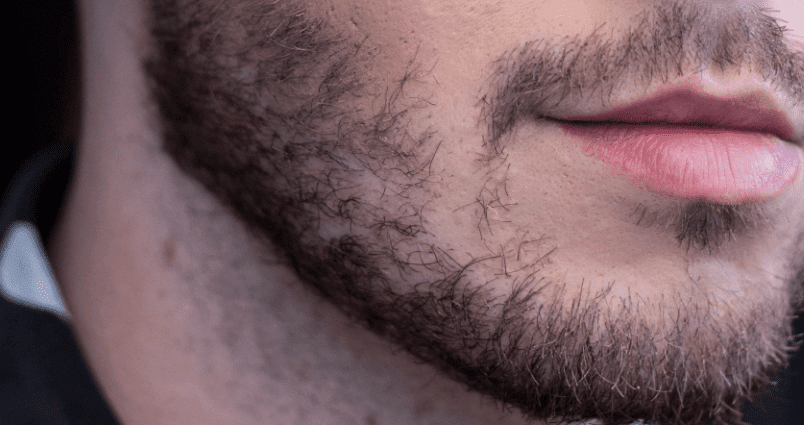 Foliculite no rosto: o que é e como cuidar?