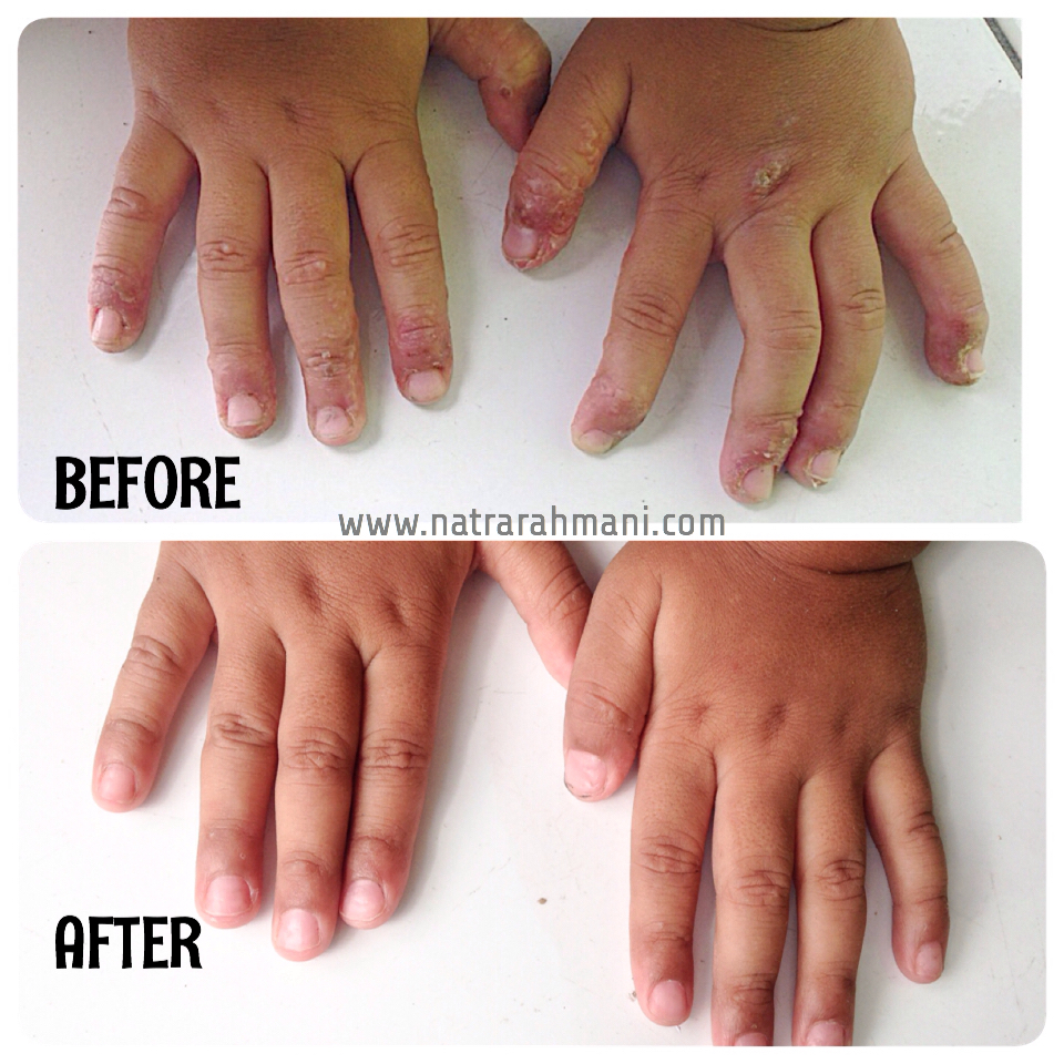 APA ITU SCABIES DAN CARA PENANGANANNYA / Natrarahmani