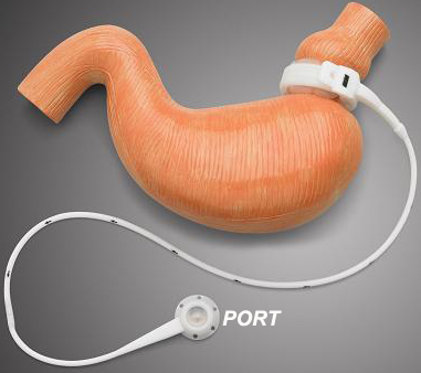 Lap Band Gal!: Weigh-in Day & My Lap-Band Port