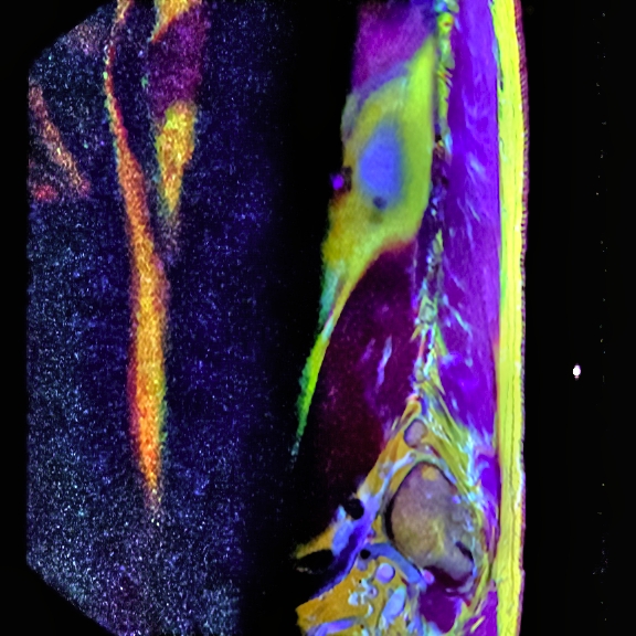 Nevit's blog: Color MRI of the Lumbar vertebrae