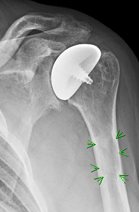 UW Shoulder and Elbow Academy: Painful resurfacing arthroplasty ...