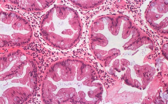 PATOLOGÍA HUMANA: PÓLIPOS INTESTINALES NO NEOPLÁSICOS