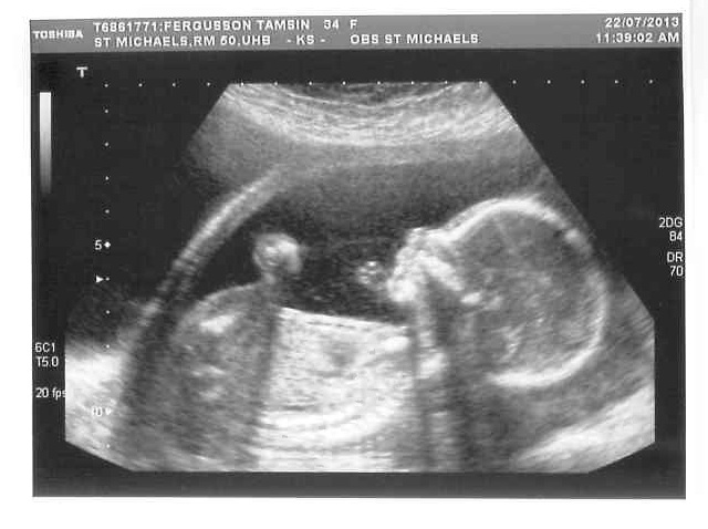 Baby Fergusson: 20 Week Scan - it's a Girl!