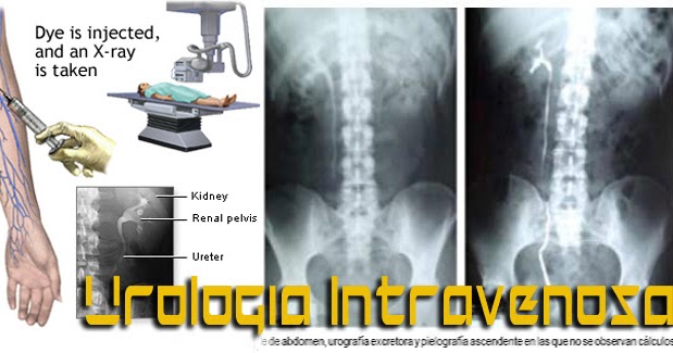 Diagnostico X: Urografía Intravenosa