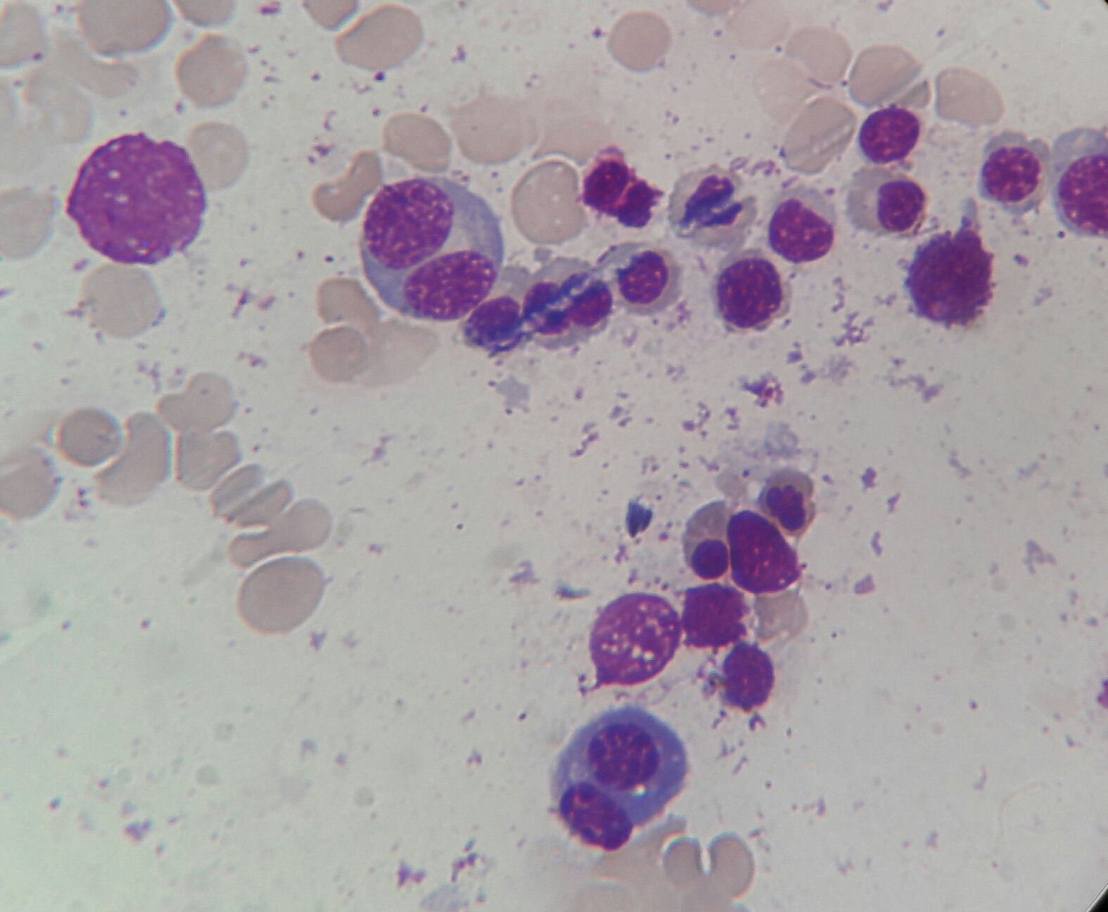 Into The Roots Erythroid Dysplasia