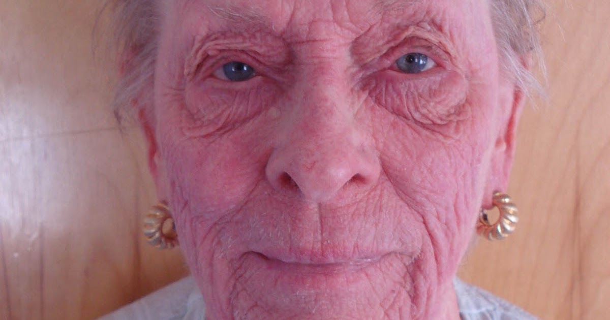 VIRTUAL GRAND ROUNDS IN DERMATOLOGY 2.0: Airborn Contact Dermatitis?