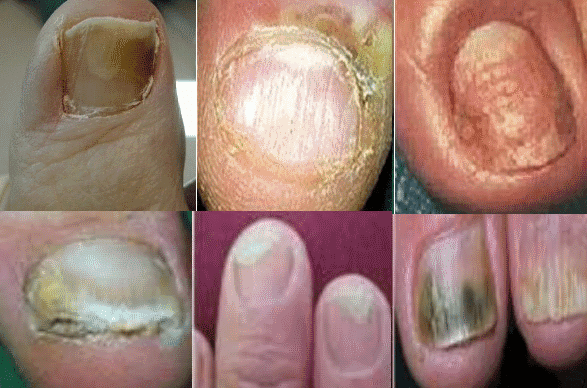 Onicomicose? Mais o que é isso? - Geri e Derme Beauty