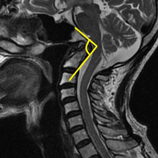 Dr Balaji Anvekar FRCR: Platybasia with Basilar invagination