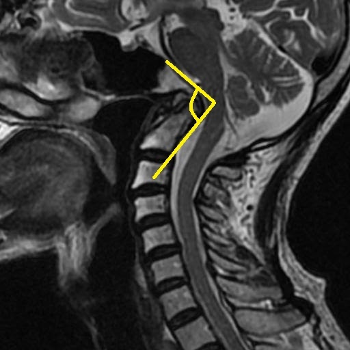 Technology and Techniques in Radiology: Clivus – Axis Angle or ‘ Angle ...