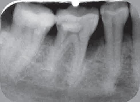 Absceso periodontal