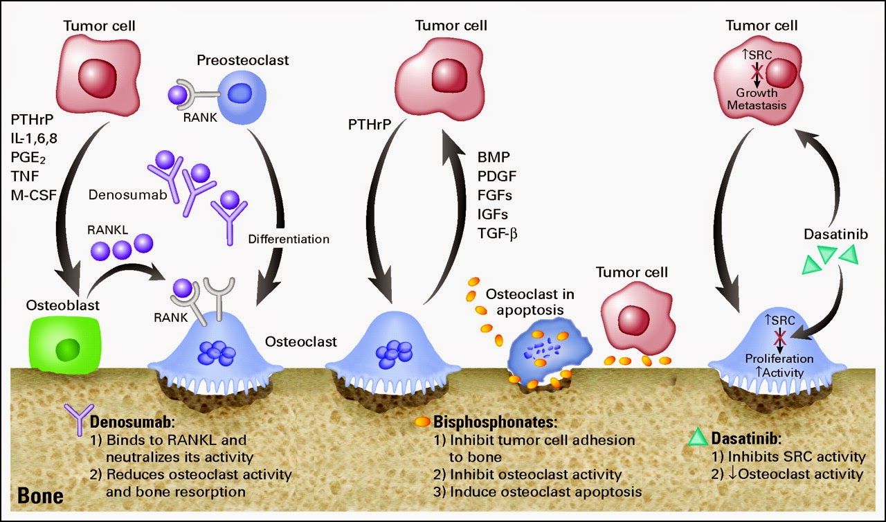 Resorción Ósea; Pérdida Ósea Osteoclástica; Reabsorción Ósea