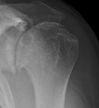 UW Shoulder and Elbow Academy: Interpositional biologic resurfacing ...