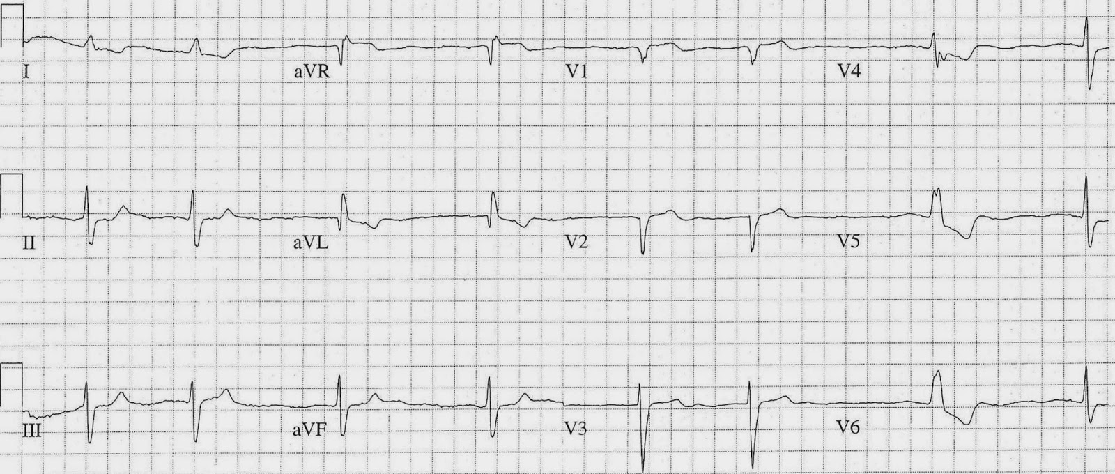 ECG of the Week: ECG of the Week - 27th April 2015