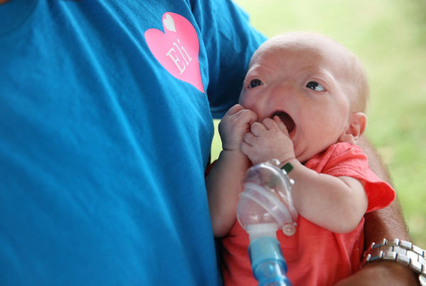 Baby Born Without Nose Is Very Cute Pictures Going Viral - Style Hunt World
