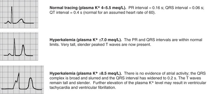 Hyperkalemia - ECG changes ~ Medicine Hack