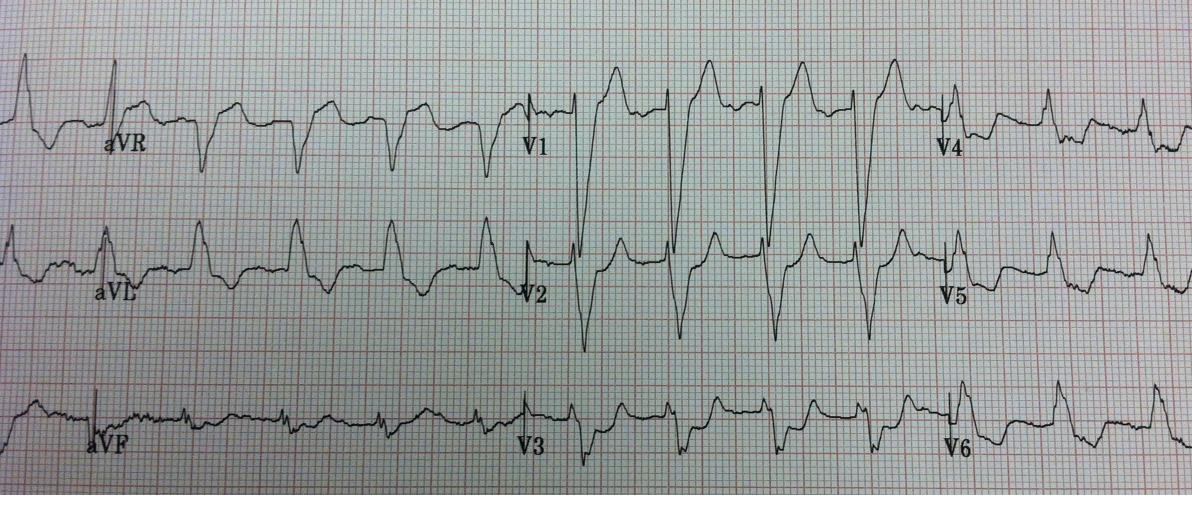 Dr. Smith's ECG Blog: Left Bundle Branch Block (LBBB) with Chest Pain ...