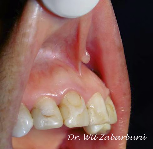 CLINICA DENTAL ASISTENCIAL: APÉNDICE DEL FRENILLO