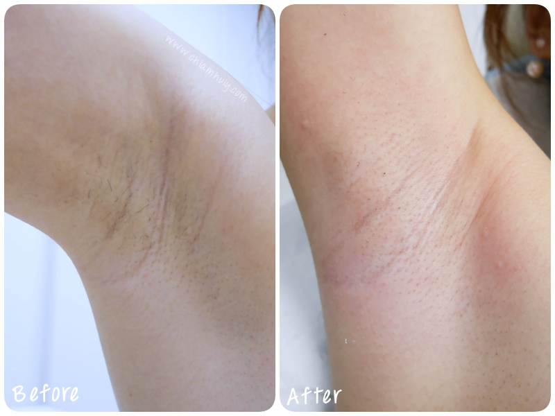 Laser Hair Removal Update | Session 4 at Dr Tyng Tan's Clinic - Celine ...