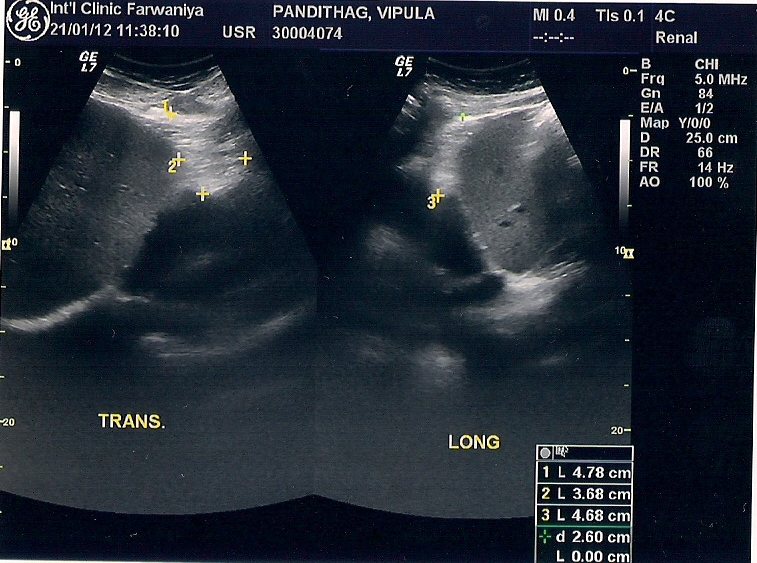 Chest Section: Pericardial pad of fat