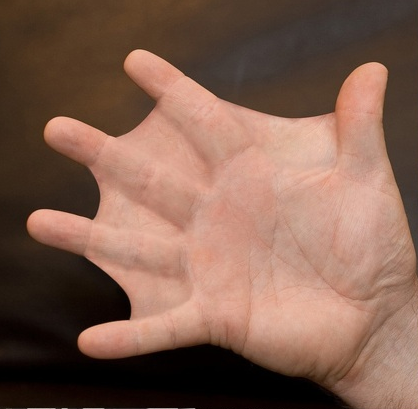 X-ray of syndactyly in a child.