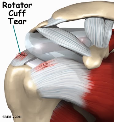 The Amazing Bodybuilding: Rotator Cuff Injury Symptoms