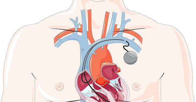 Leadless Cardiac Pacemaker: Does Anatomical Position at Implant Affect ...
