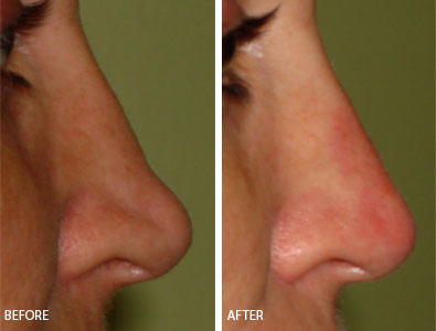 DermaSphere: No Surgery Nose Job