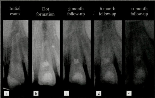 Dental Cases Reports: Pulp Revascularization in a primary Necrotic ...