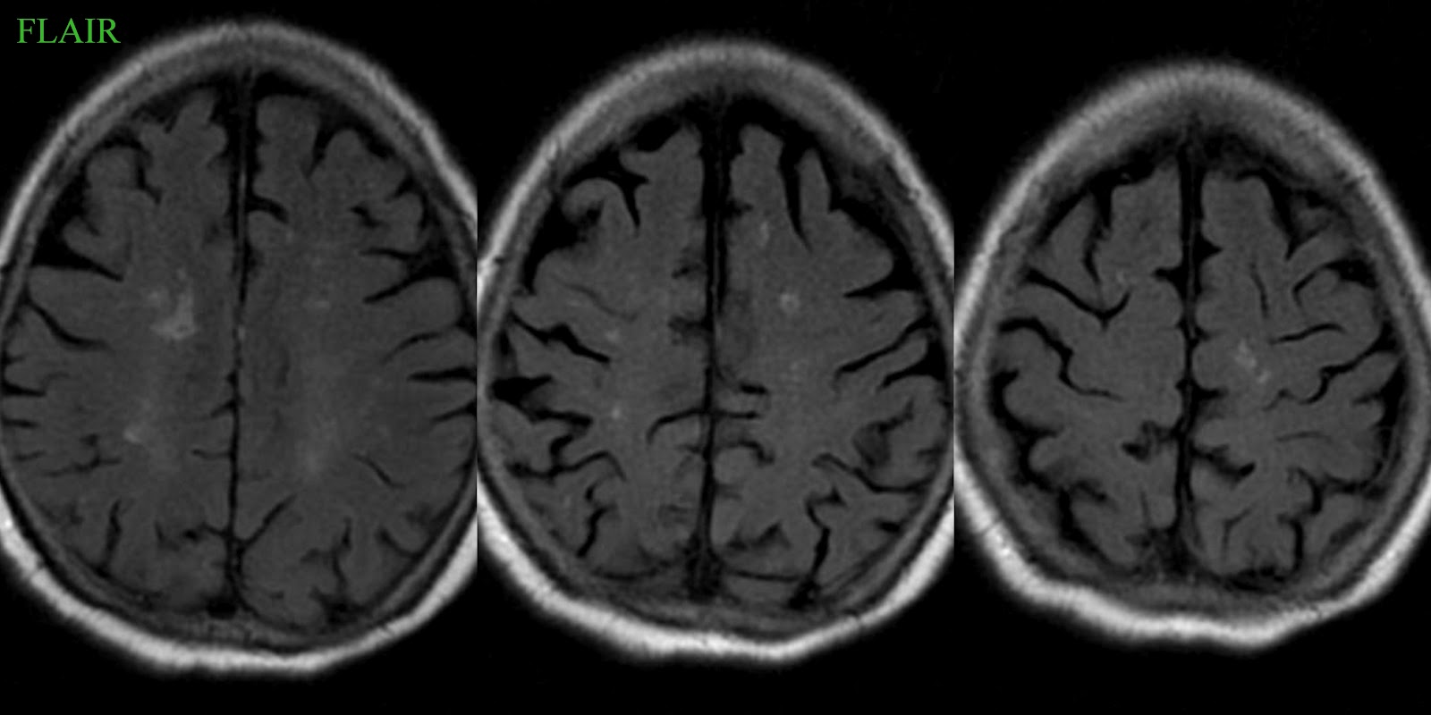 Dr Balaji Anvekar FRCR: Superficial Siderosis MRI T2*GRE Brain