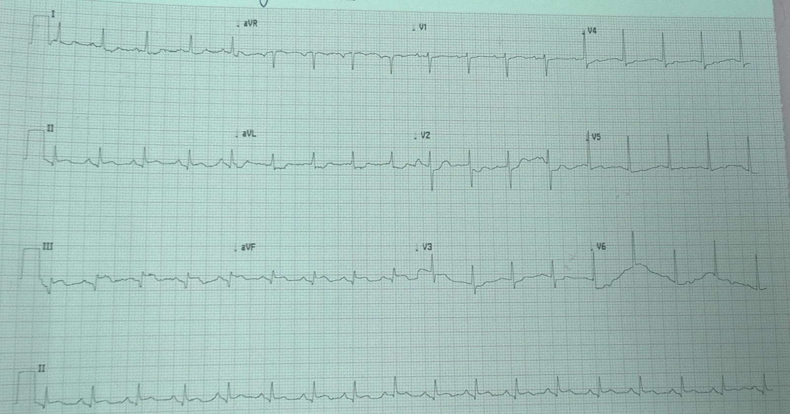 Cardiology window: Inferior wall with posterior wall with right wall ...