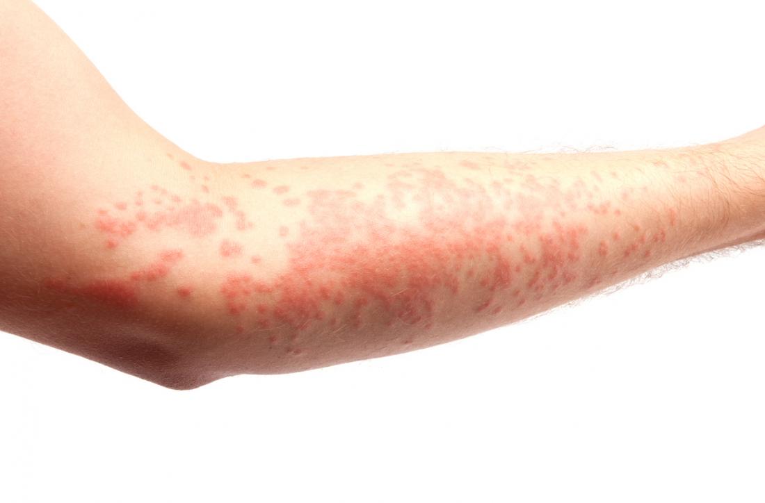4 Most Popular Causes & Symptoms of Eczema
