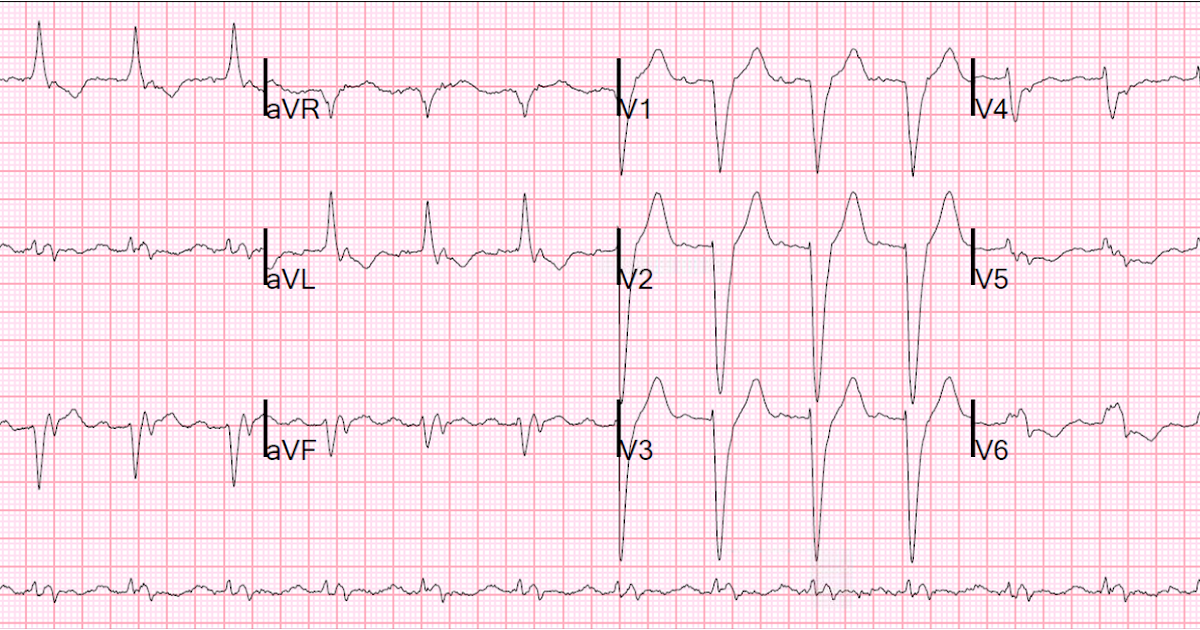 Dr. Smith's ECG Blog: CHF Exacerbation with Old LBBB: Is There New ...