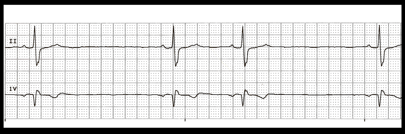 EKG Rhythm Quiz 225