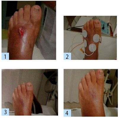 Microcorrentes X Reparo Tecidual ~ RECURSOS TERAPÊUTICOS FÍSICOS