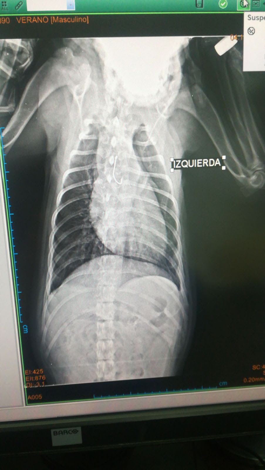 BLOG DE VICENTE PEÑA: Anzuelo en esófago torácico: esofagotomía de urgencia